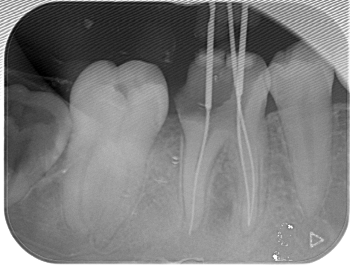 periapical_new_data_test_alt Object Detection Dataset by croni
