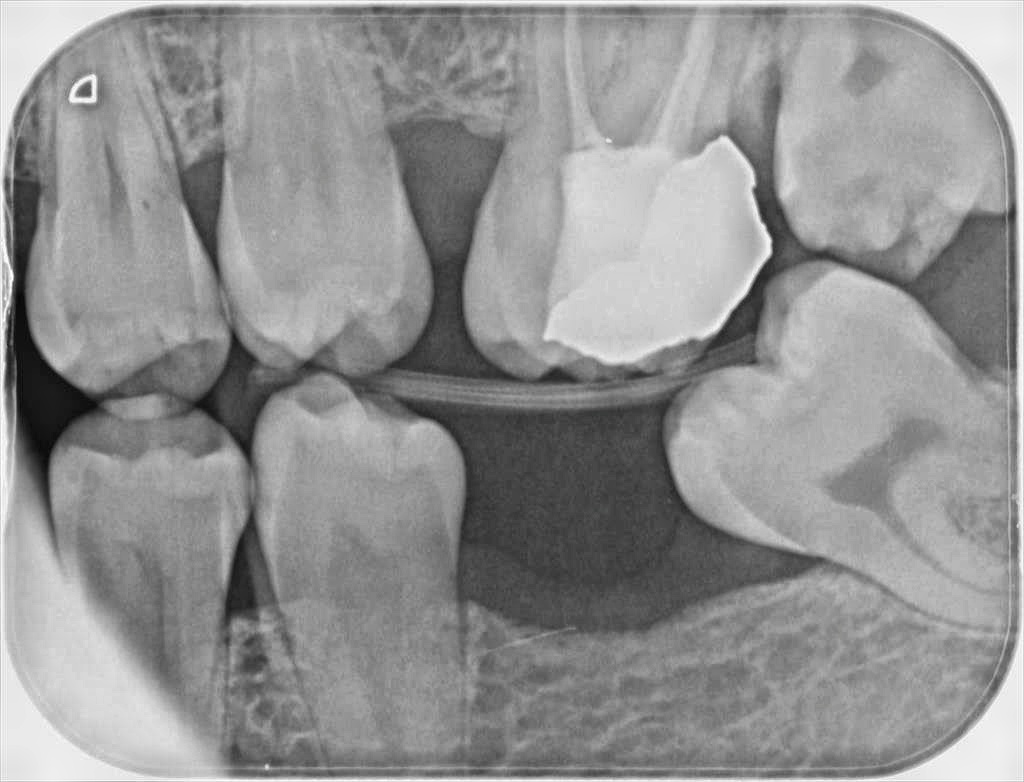 Bitewing_sol_aug_train Instance Segmentation Dataset by croni