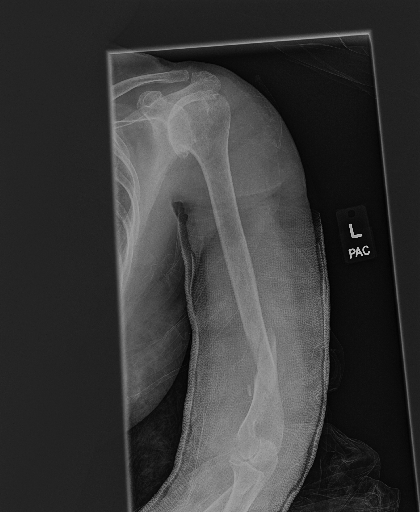 Humerus Classification Dataset by deepray