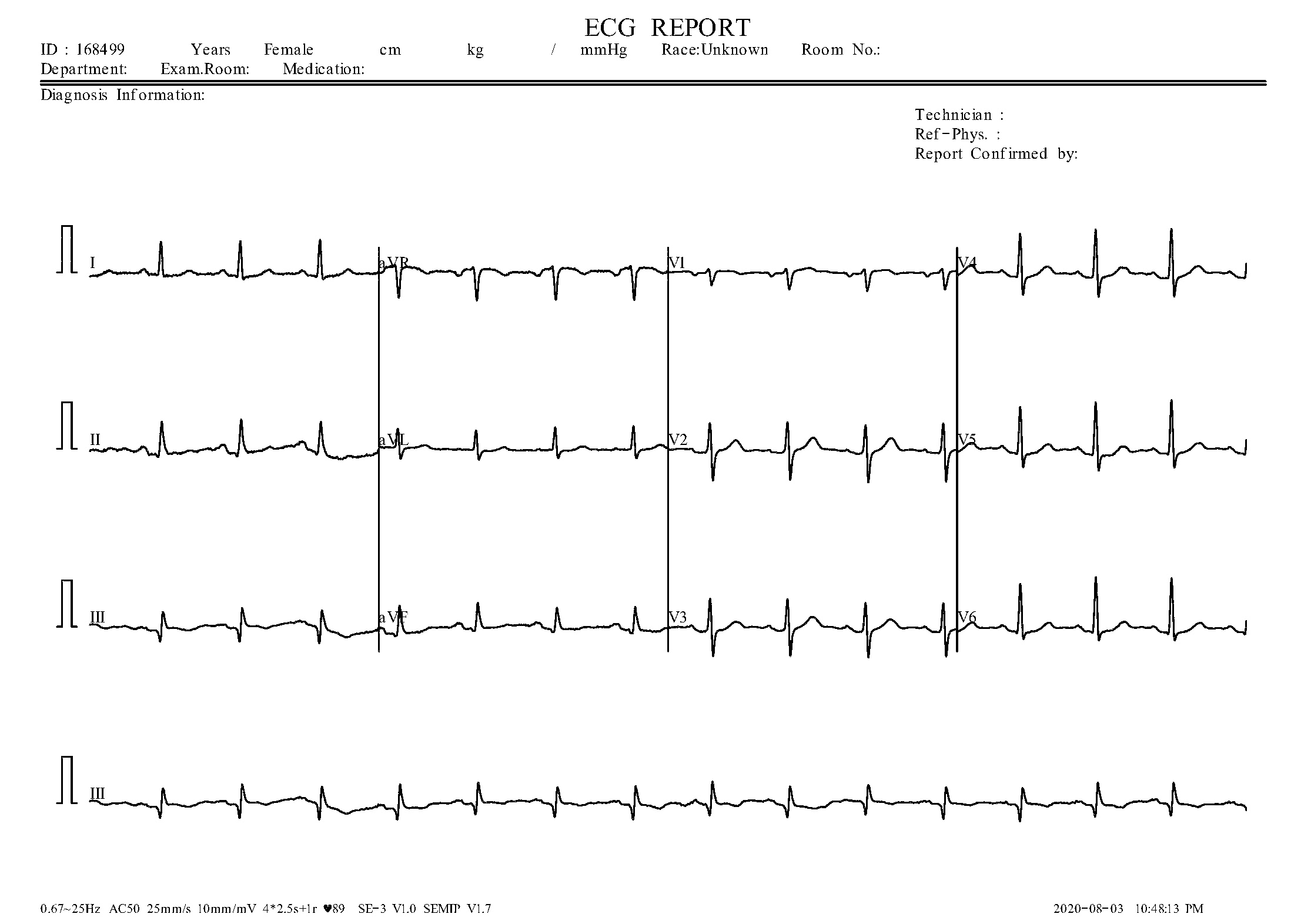 ECG for MI Object Detection Dataset by ECG