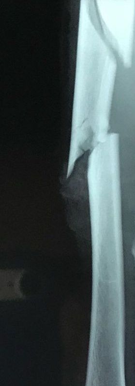 Tibia_All_Gr2 Object Detection Dataset and Pre-Trained Model by Femur