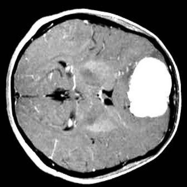 brain tumor Classification Dataset and Pre-Trained Model by indianserves