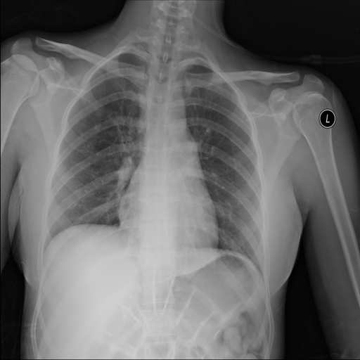 Tuberculosis v2 Classification Model by PROJECTS
