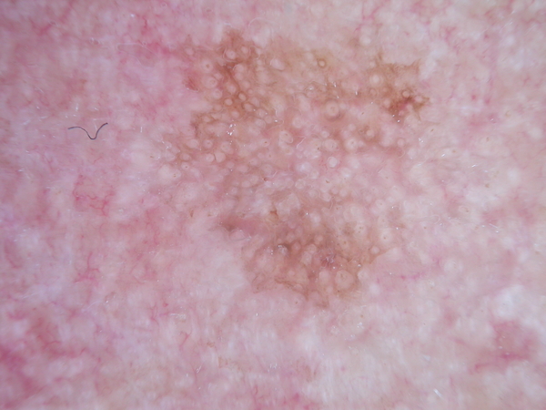 Skin Cancer Object Detection Dataset By Ai