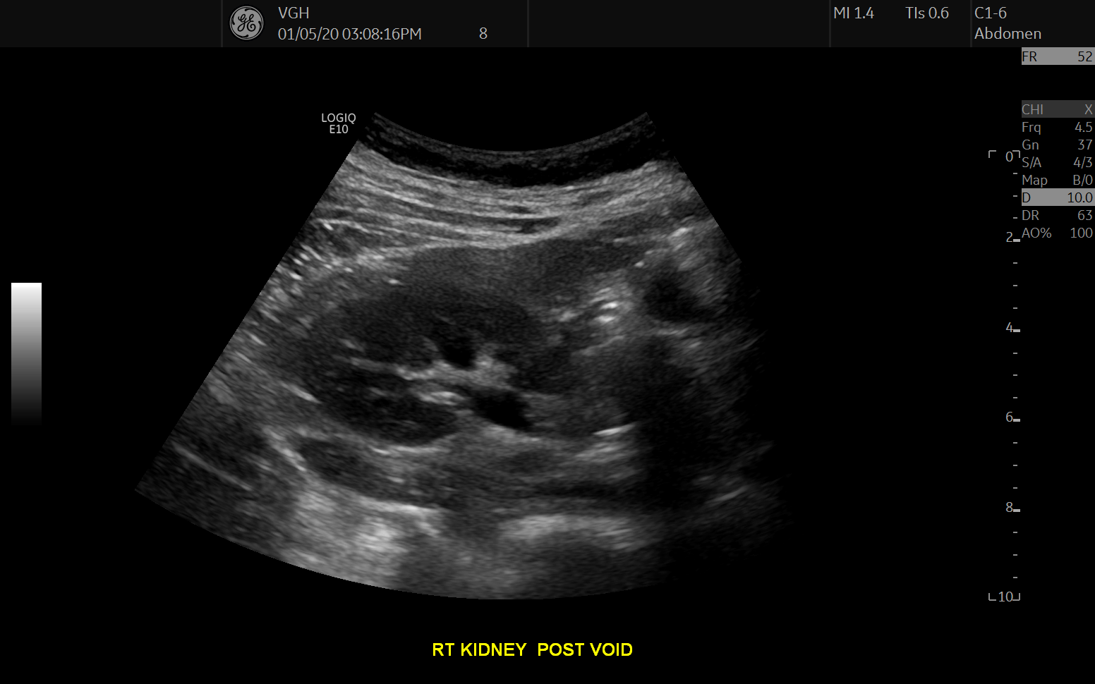 Ultrasound Normal KIdney Image Instance Segmentation Dataset by JeevaWS
