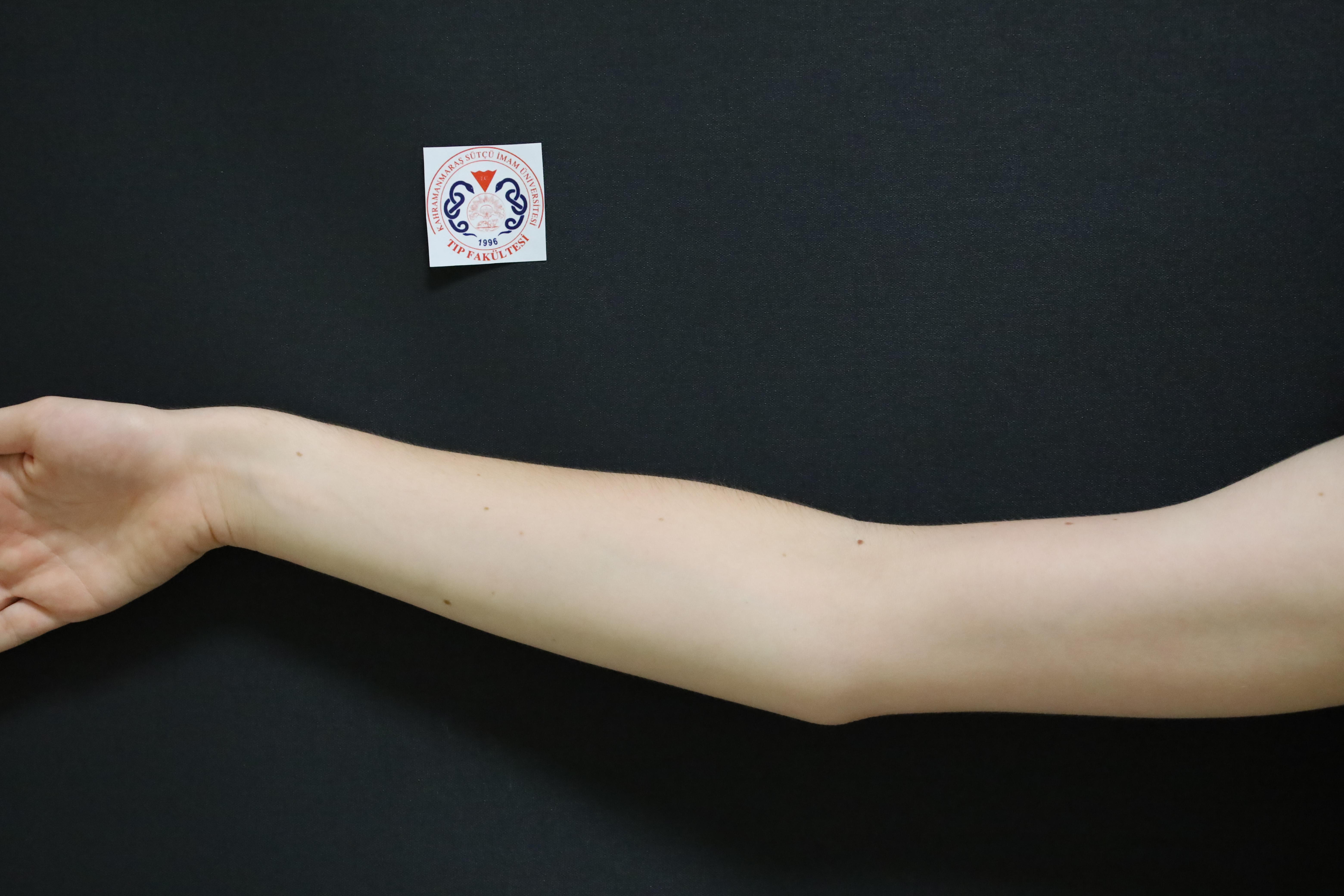 Nevus_segmentation Instance Segmentation Dataset and Pre-Trained Model by NevusDetection