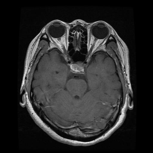 tumor identification Classification Dataset by wang