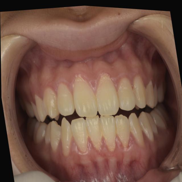 Yolo Gingivitis Object Detection Dataset And Pre Trained Model By Gingivitis