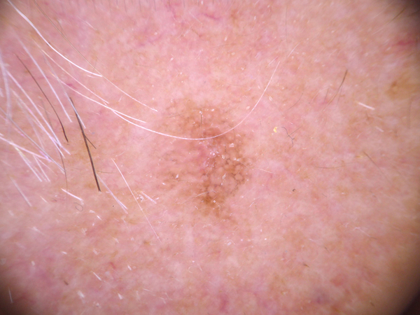 Skin Cancer Detection Object Detection Model by hello