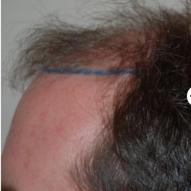 hairline Instance Segmentation Dataset by hello