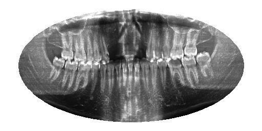 How to Use the x ray tooth decay Instance Segmentation API