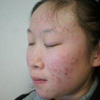 Facial Skin Object Detection Dataset by phamphong