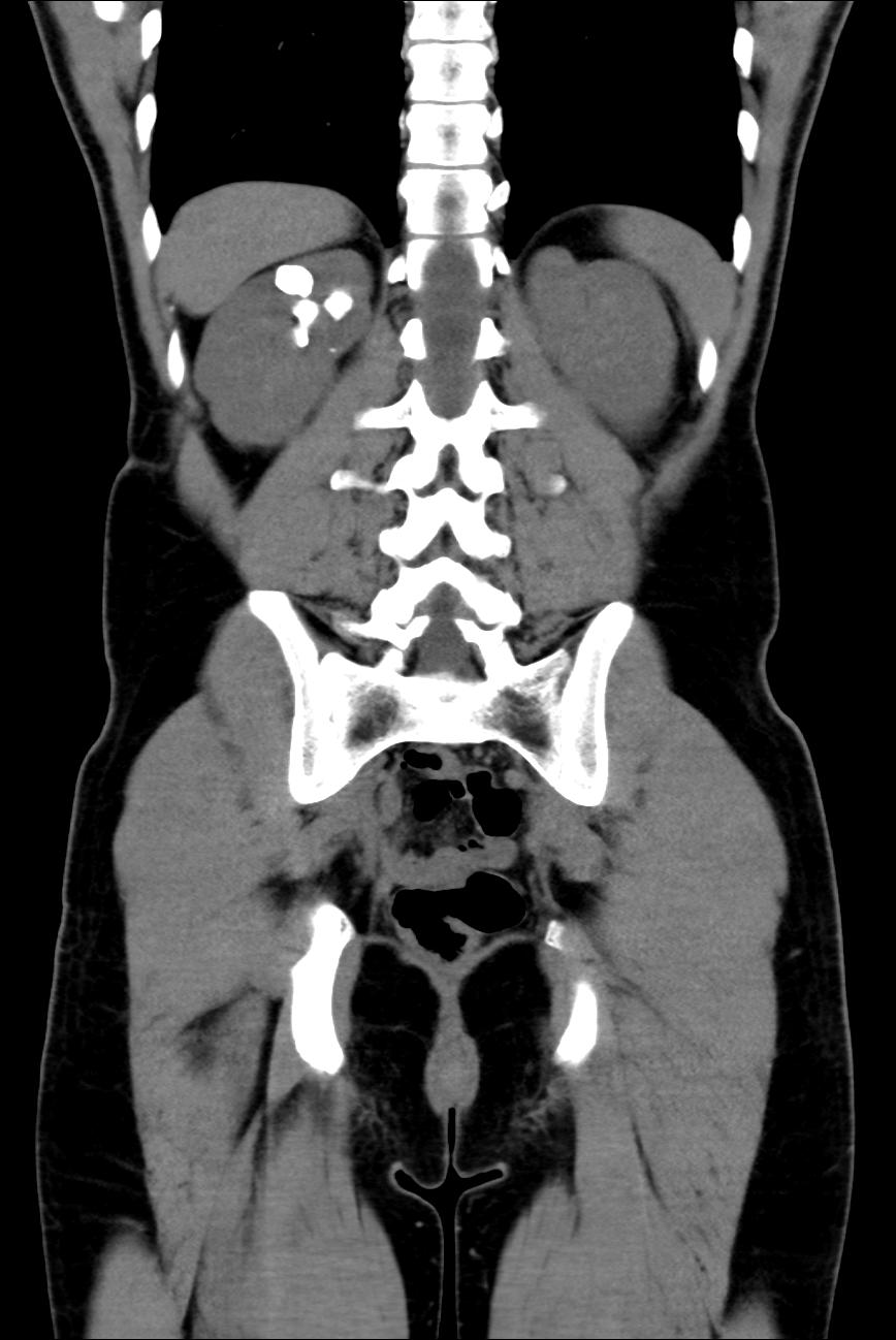 stone Instance Segmentation Dataset by zubair