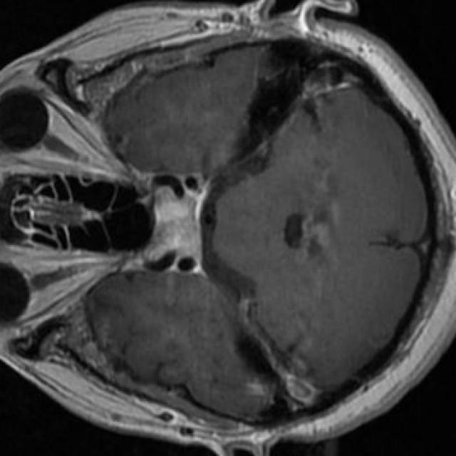 Brain Tumor Object Detection Model V1 2024 07 04 4 16pm By Academia