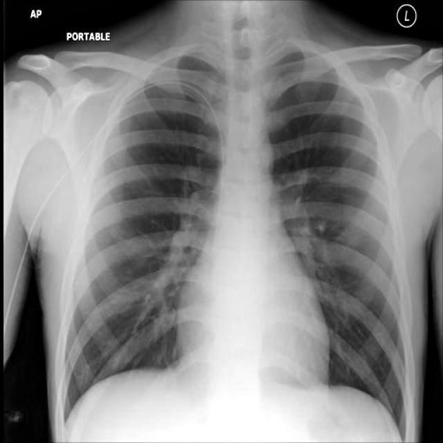 tbc detection Classification Model by tbc detection