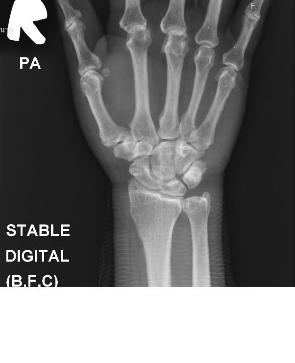 Segmentation Bone Instance Segmentation Dataset By Projectwristbone64