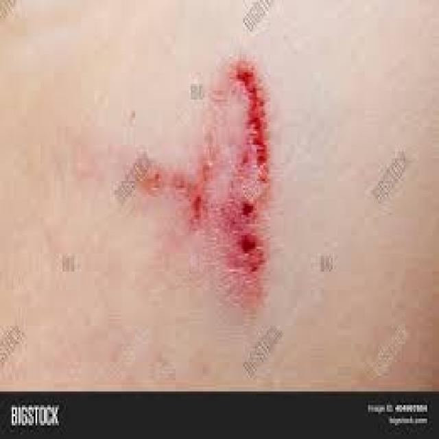 wound2 Object Detection Dataset by dongdong