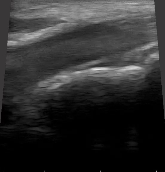 Longitudinal view Instance Segmentation Dataset by Surgical AI