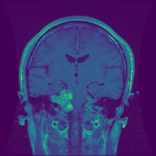 Tumor Object Detection Model by CICpatternclassification