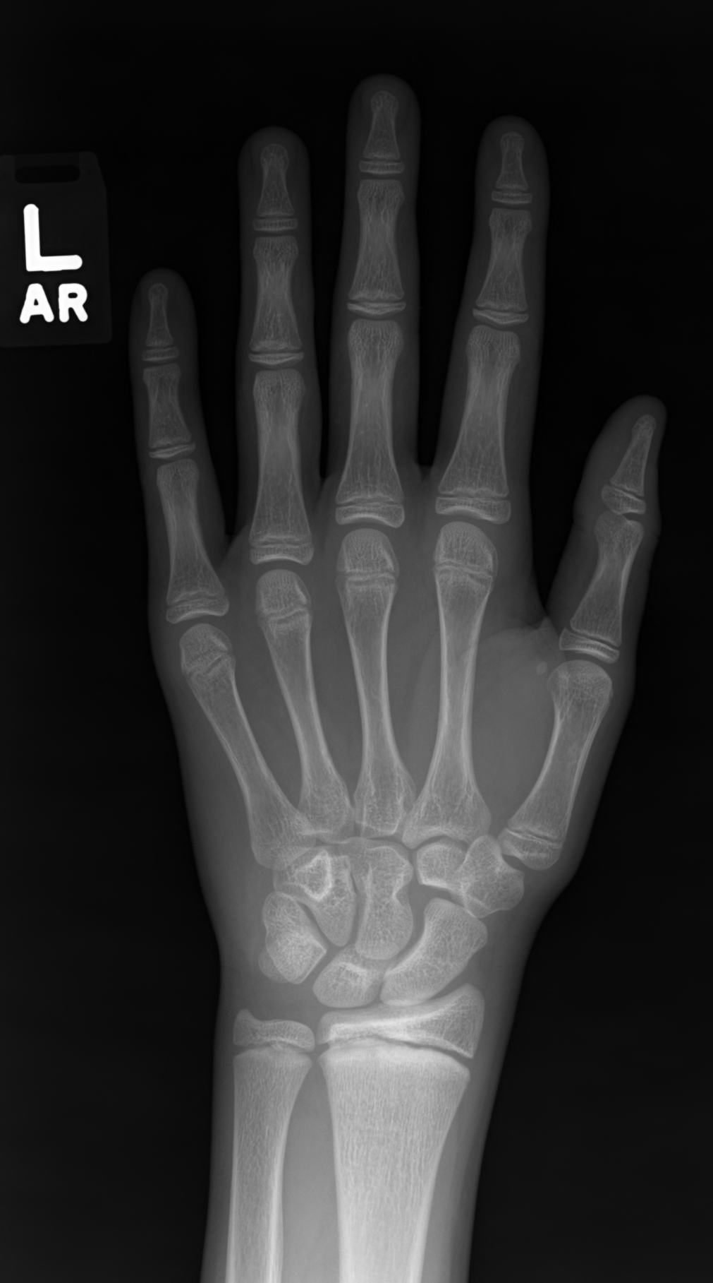 boneage-object-detection-dataset-and-pre-trained-model-by-bond-gg