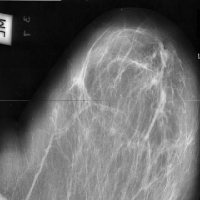 BreastCancer Object Detection Model by breastcancer