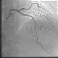 coronary artery segmentation - Roboflow Universe