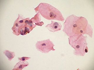 Pap Smear - Cancer Detection Object Detection Model by Cancer Anotation