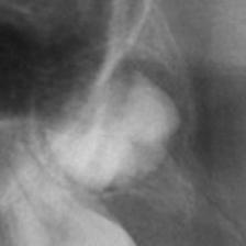 Winter's Classification Object Detection Model by Third Molar