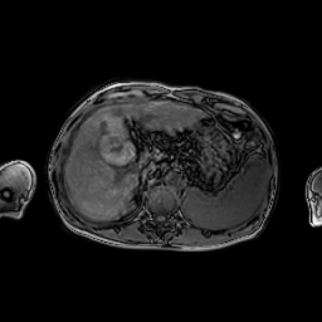 liver-tumor Object Detection Dataset by Ask123