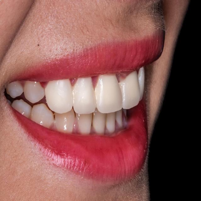 Cavity Detection Classification Classification Dataset By Minor Project