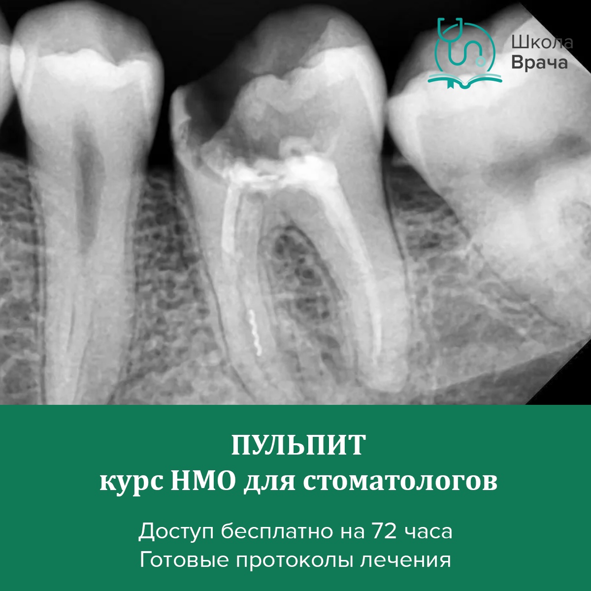 Caries 1 class Object Detection Dataset by Minor Project