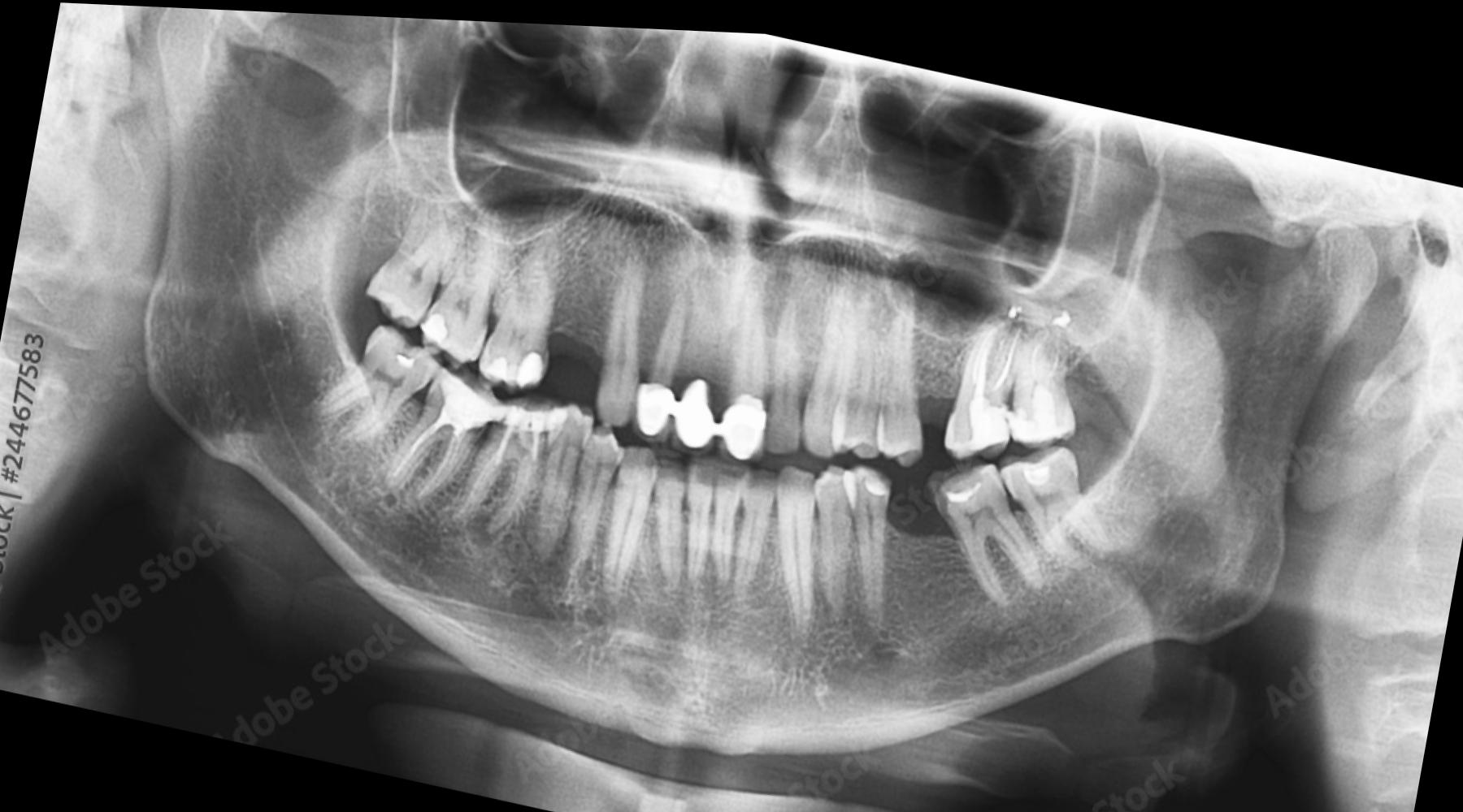 teeth Object Detection Dataset and Pre-Trained Model by teethnumbering