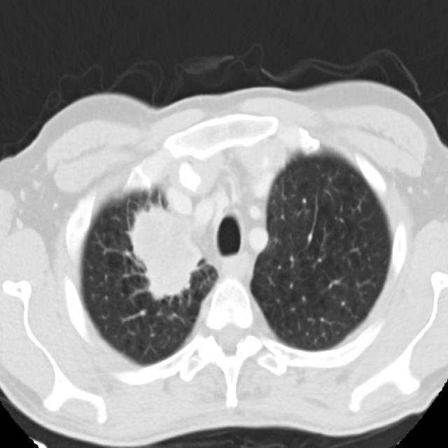 autoSAM-dataset Instance Segmentation Dataset and Pre-Trained Model by lung
