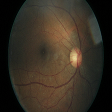 db_retina Classification Model by education