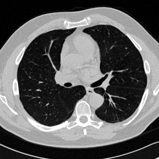 lung_ct_version_n Object Detection Dataset by Water Meter