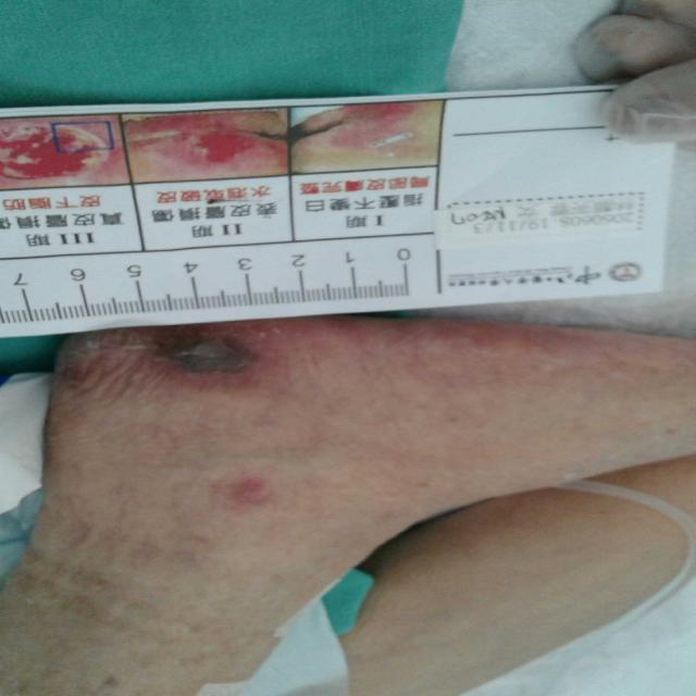 Pressure Ulcer Object Detection Dataset V2 2024 04 27 5 48am By Stage2