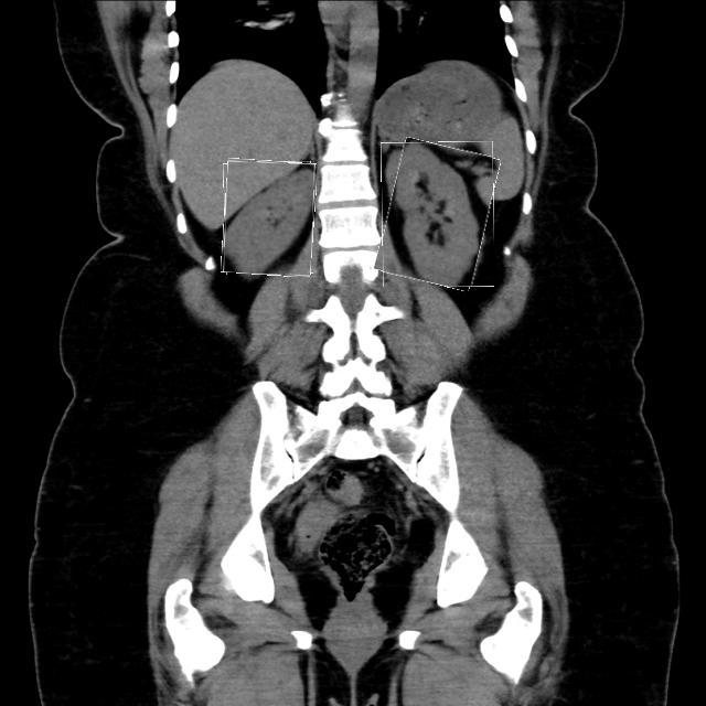 Kidney stone detection Object Detection Model by KSD2