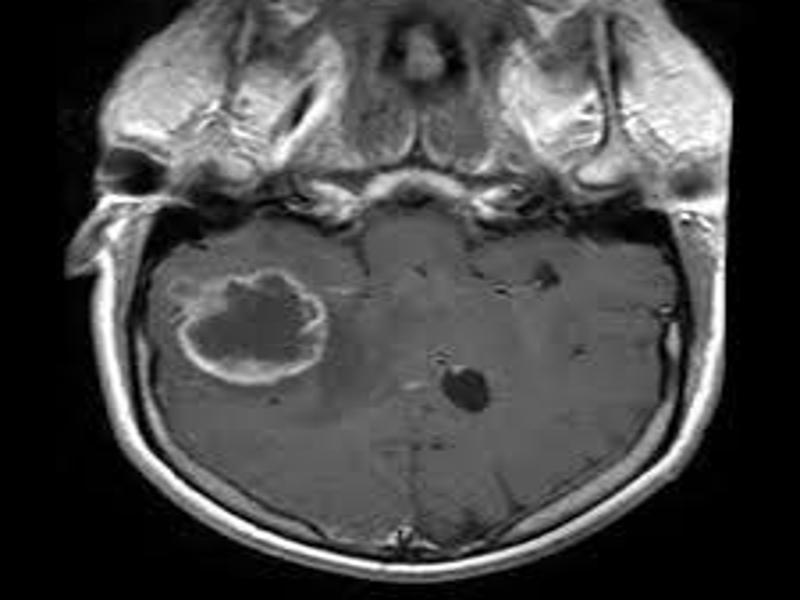 glioblastoma Instance Segmentation Model by zafair