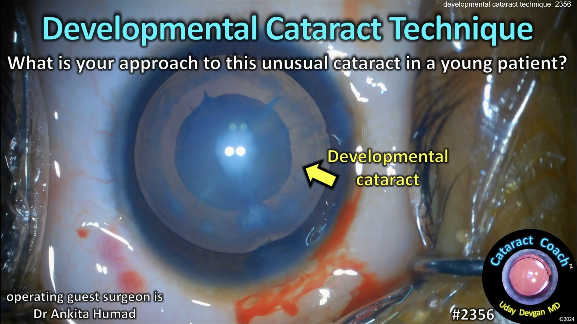 S Cc 2356 Developmental Cataract Instance Segmentation Dataset By Ai