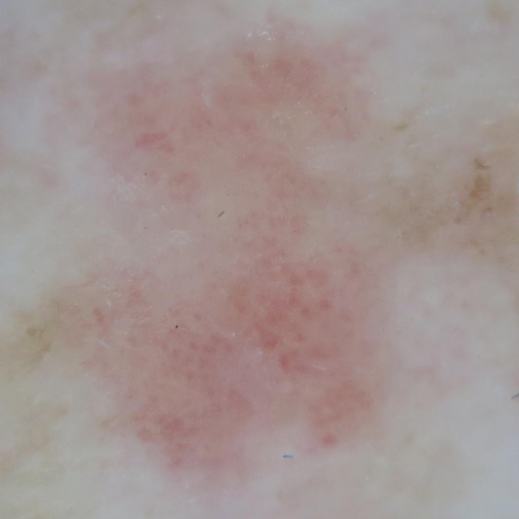 Skin Cancer Object Detection Model by First