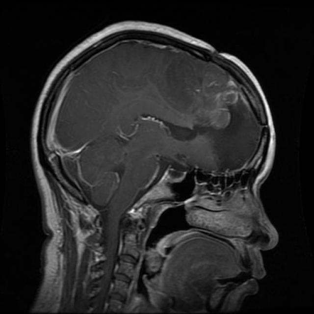 Brain MRI Instance Segmentation Dataset by RisetMe