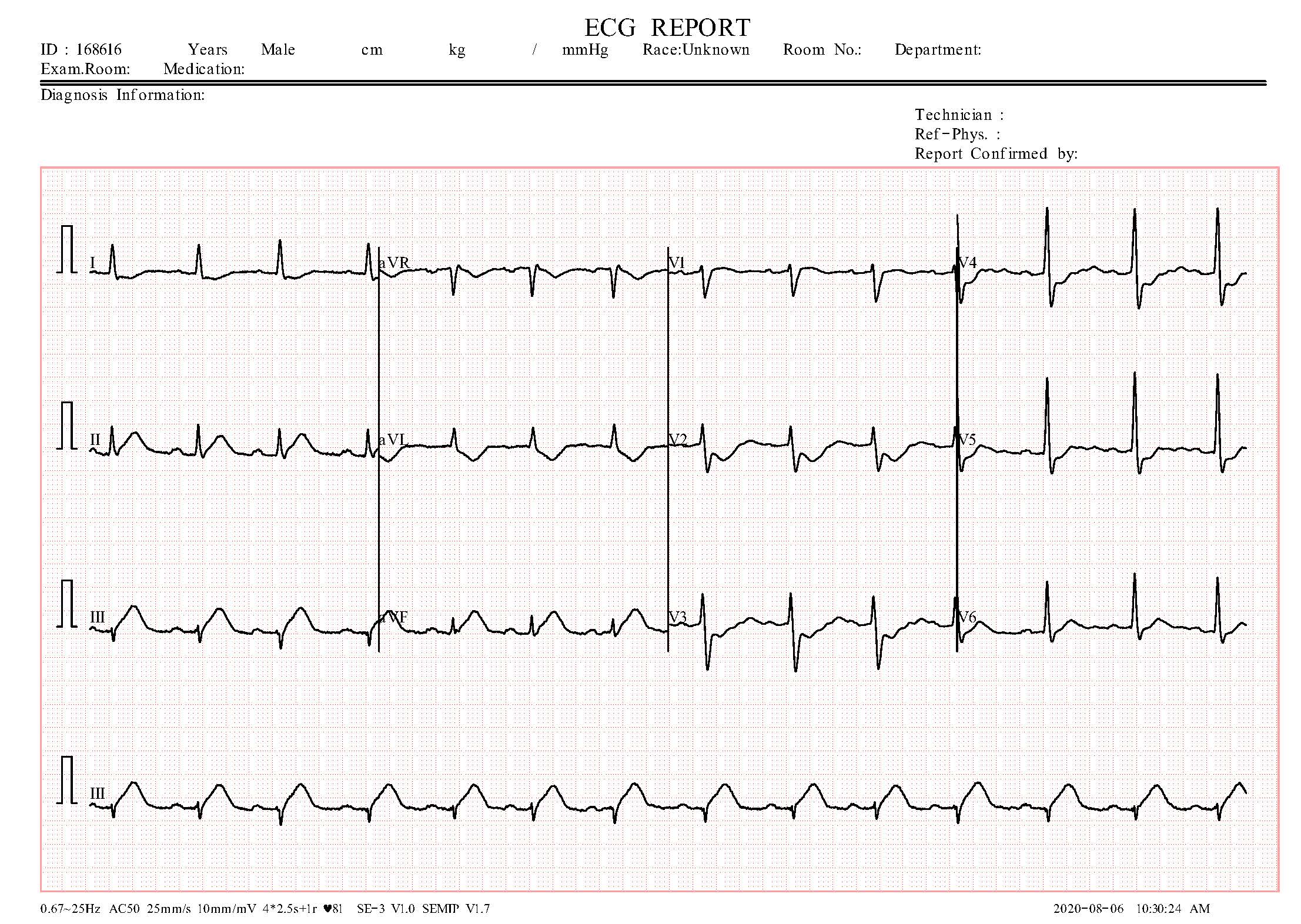 ECG Classification Classification Model by ECG