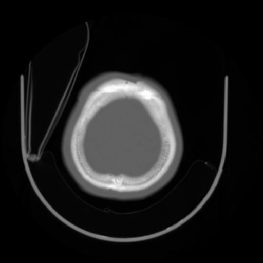 Skullfracture Object Detection Dataset And Pre Trained Model By Fracture