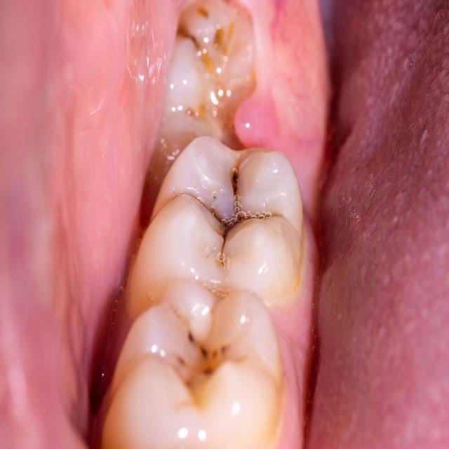 Caries Classification ICDAS II Object Detection Dataset and Pre-Trained Model by Abhinavs Workspace