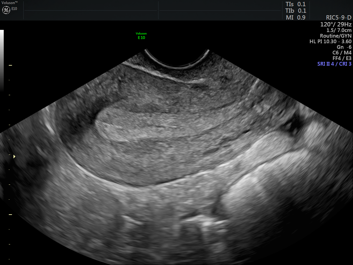Endometrium Receptivity Instance Segmentation Dataset by Endometrium ...