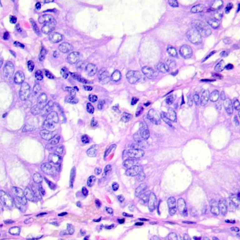 cancer detection updated Object Detection Model by school
