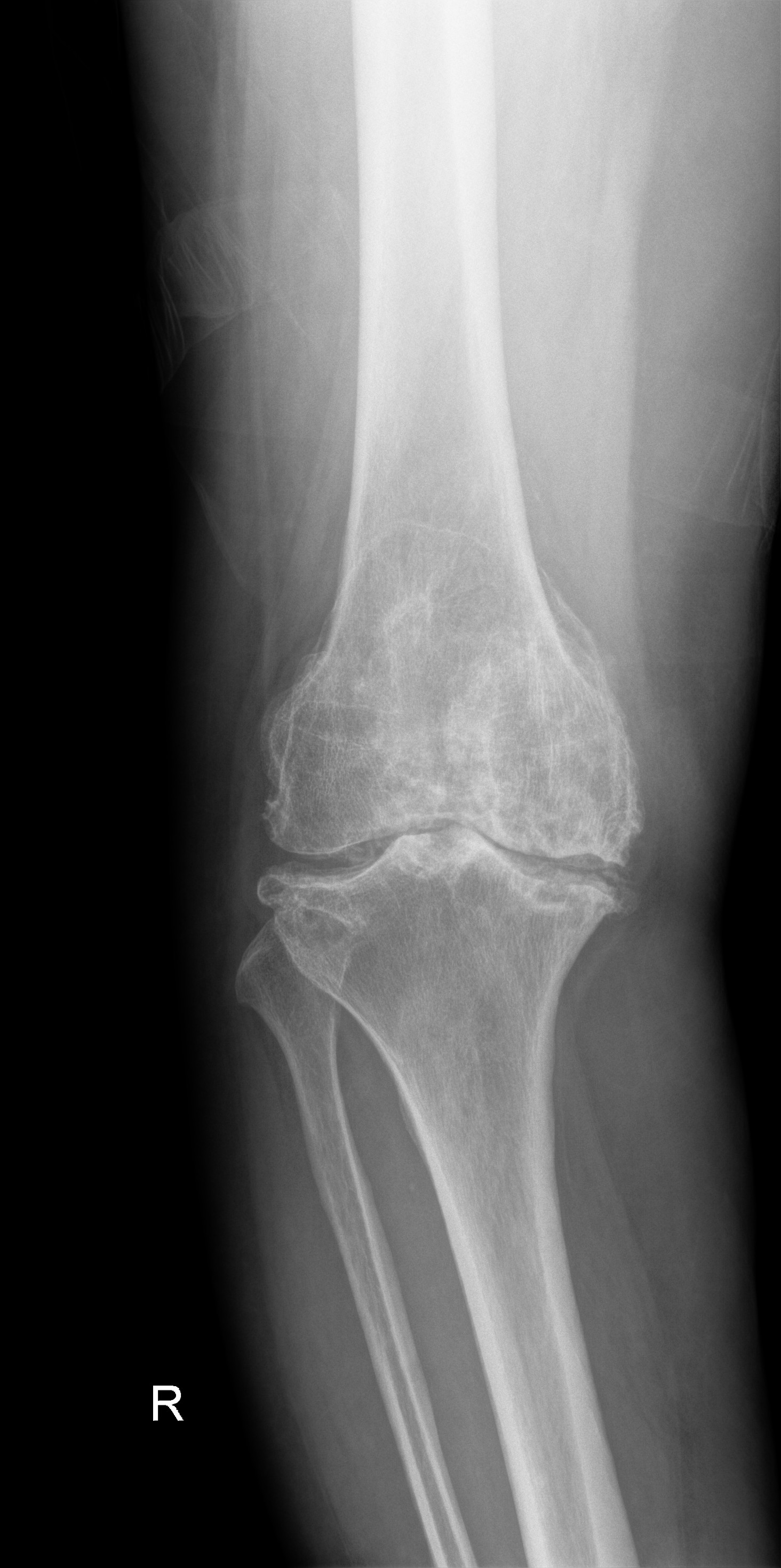 Knee Object Detection Dataset by Knee Prosthesis