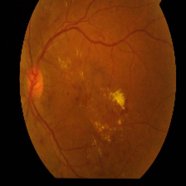 DR_Classification Classification Dataset and Pre-Trained Model by TU6
