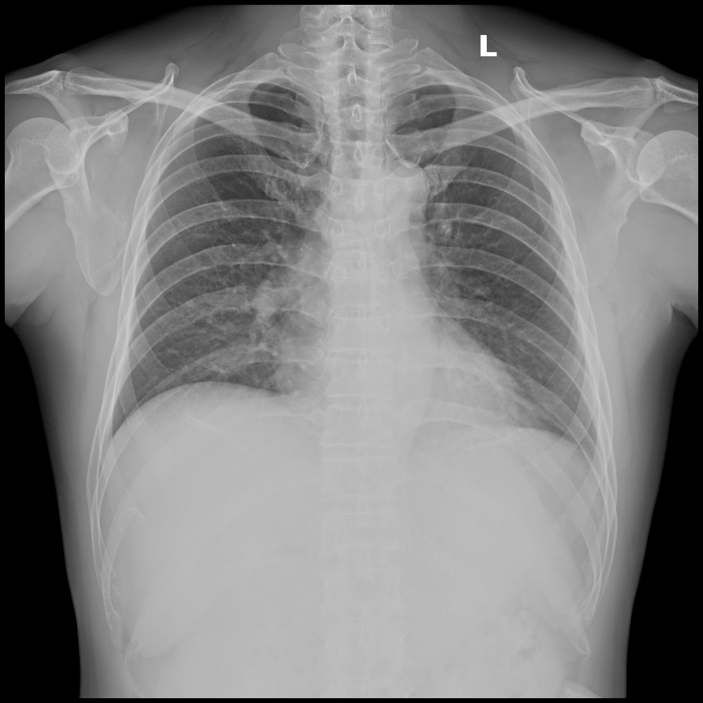 Lungs Object Detection Dataset by 4EyedMonkey