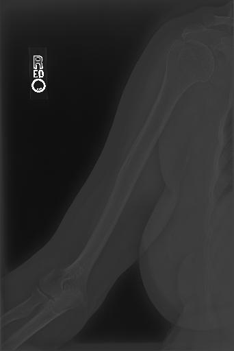 Bone Fracture Detection Two classes Object Detection Model by ...